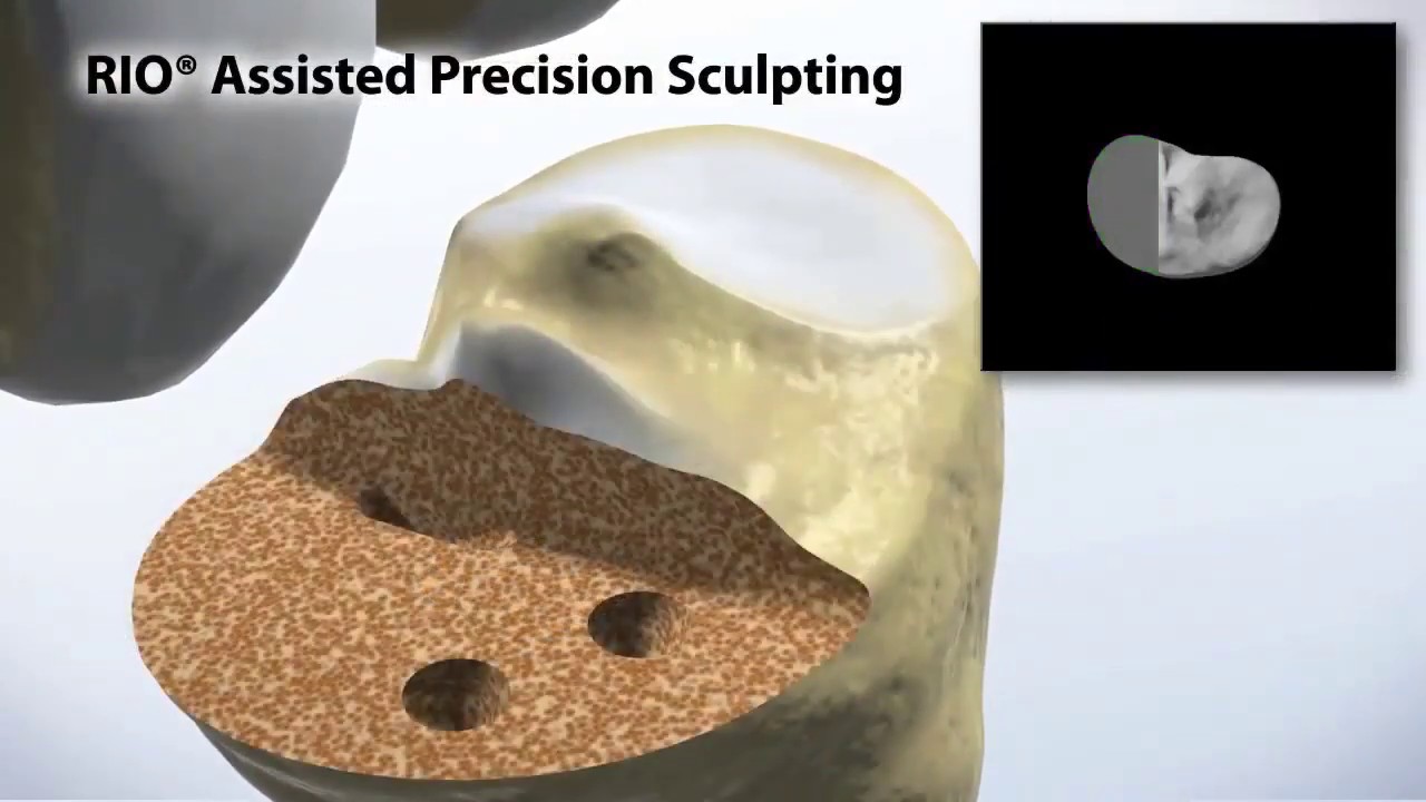 Dr. Paul Jacob, an Orthopedic Surgeon offers Makoplasty Knee ...