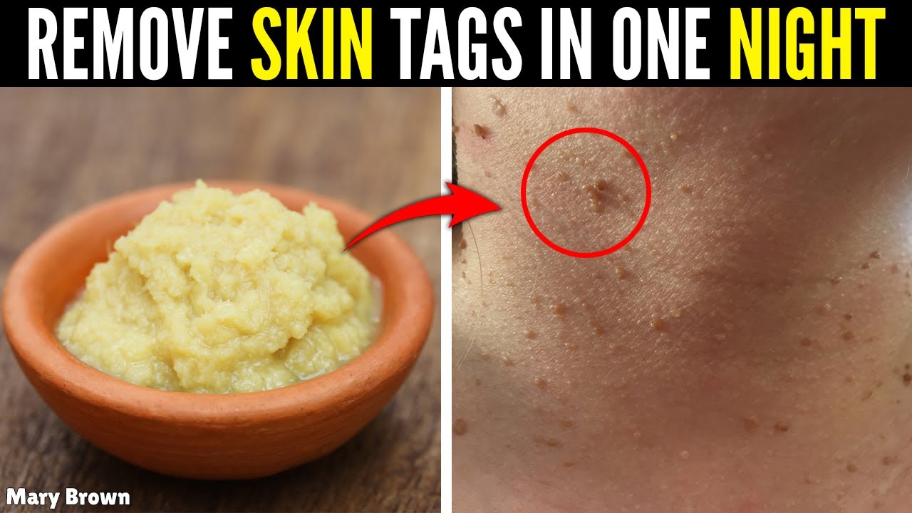 How to Get Rid of Skin Tags at Home in One Night - YouTube