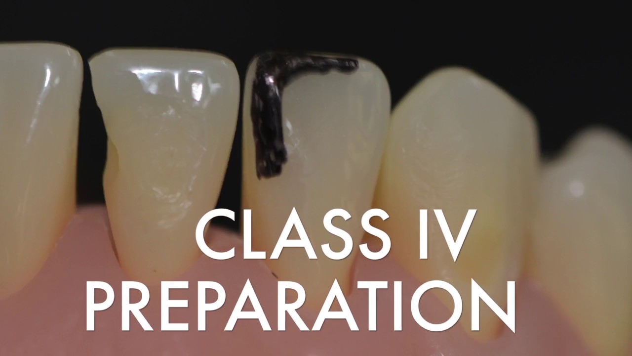 Class IV Preparation for Resin Composite - YouTube