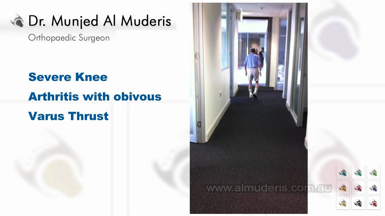 Severe Knee Arthristis with Obvious Varus Thrust - YouTube
