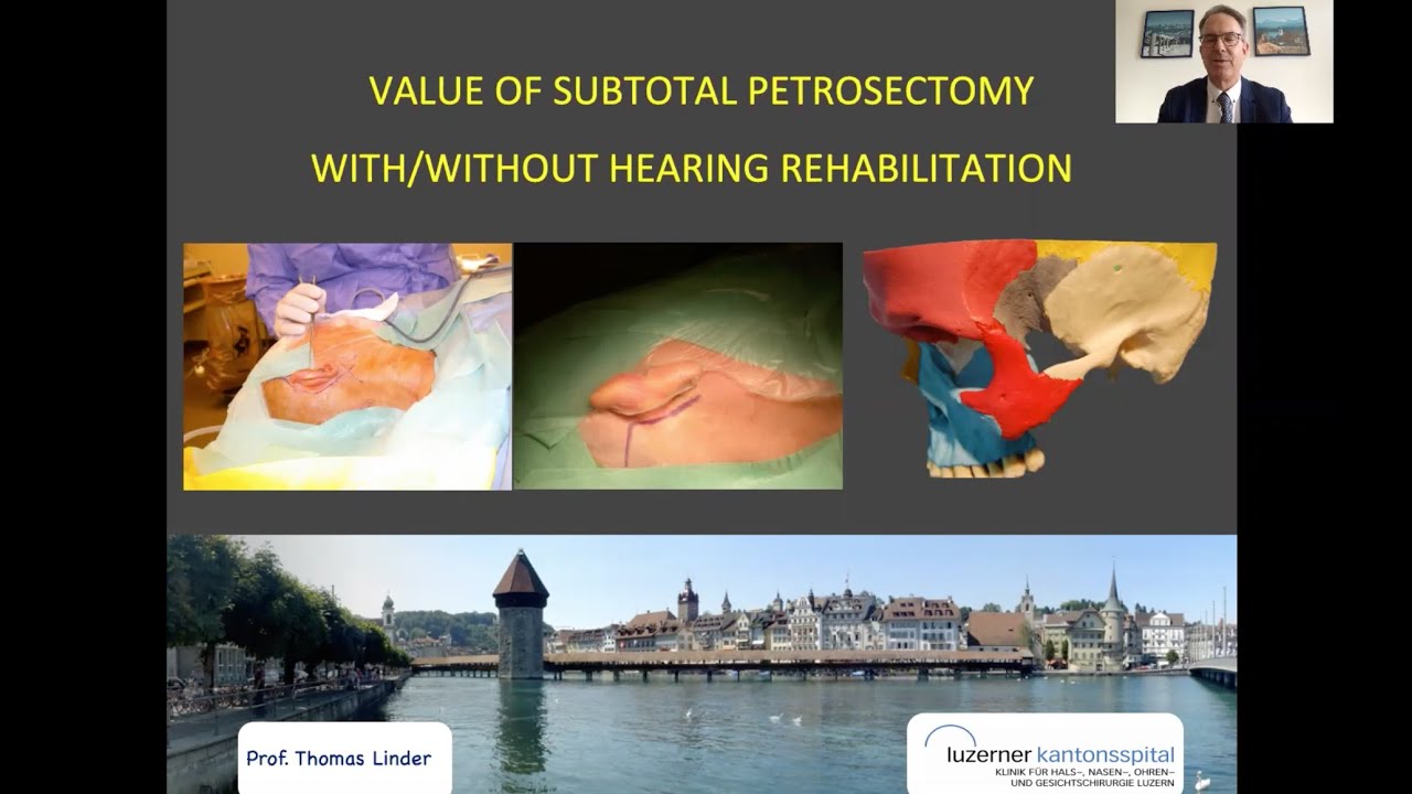 Introduction to Subtotal Petrosectomy Lecture by Prof. Thomas Linder ...