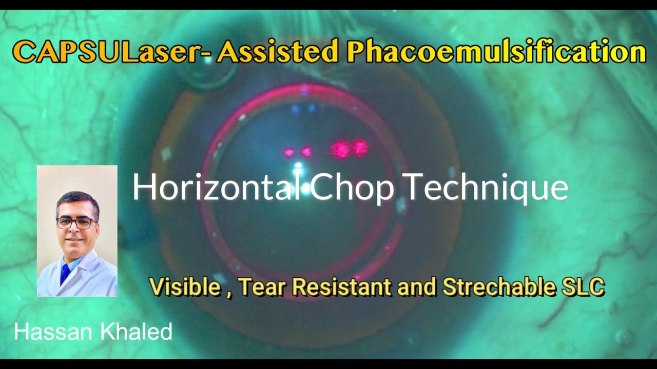 CAPSULaser -Assisted Phacoemulsification ,Horizontal Chop Technique ...