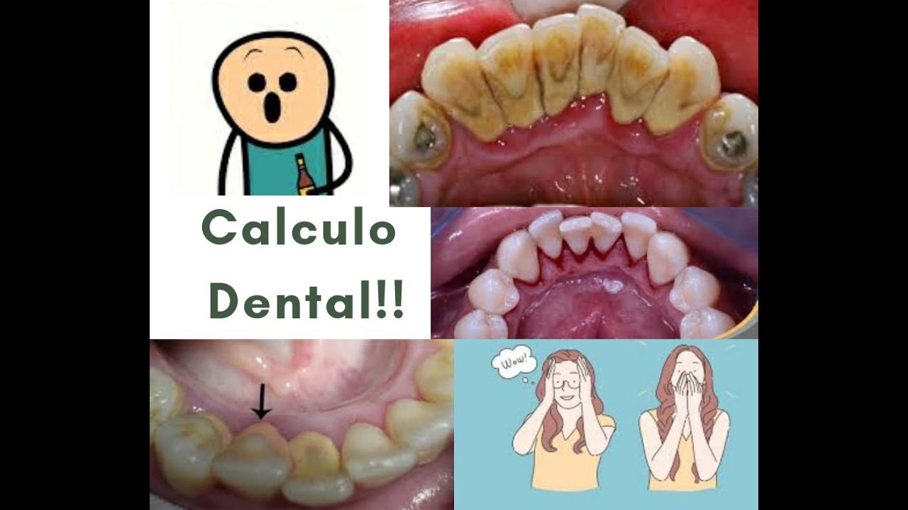 Calculo dental/sarro dental que es? como se forma? - YouTube