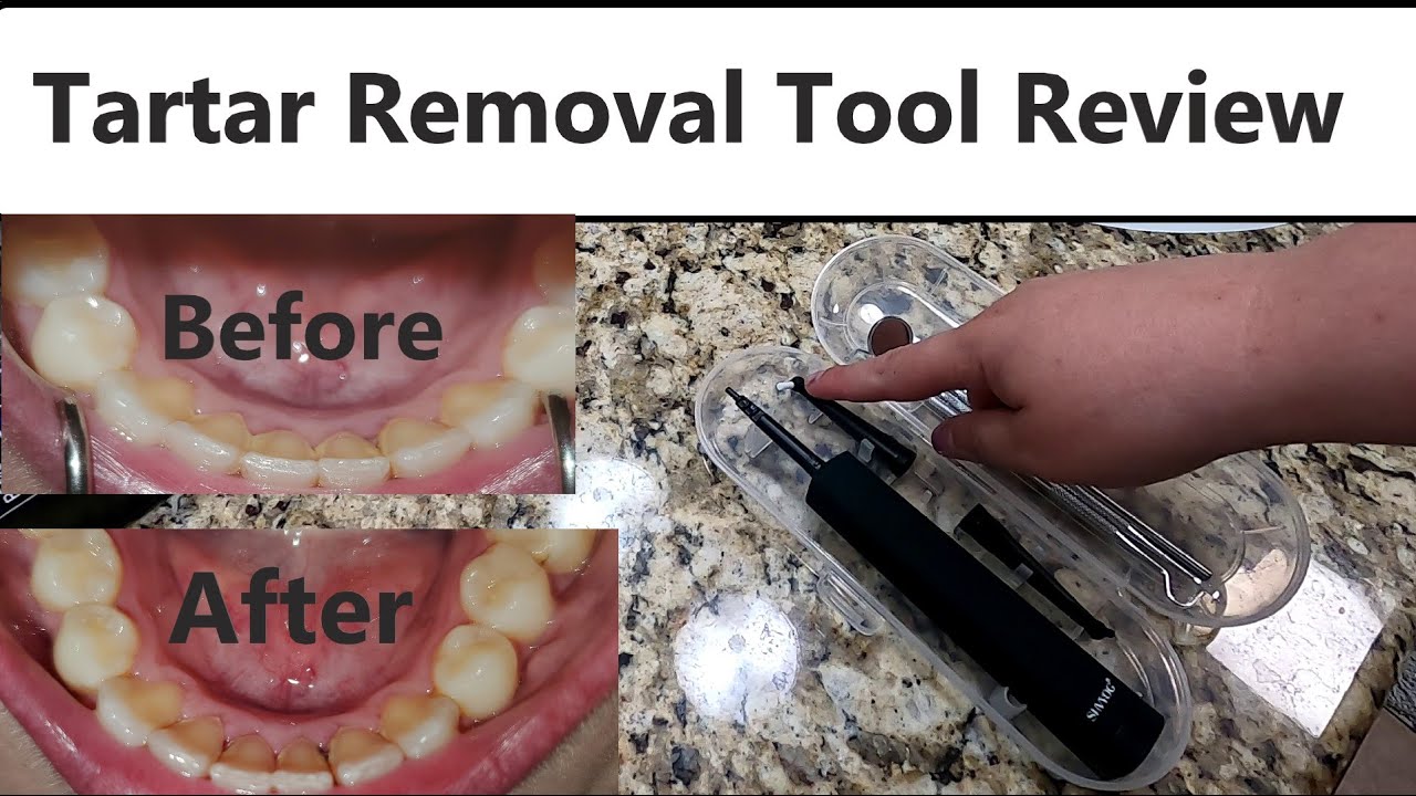 Calculus Tartar Removal Tool Review | Aerica Lee - YouTube