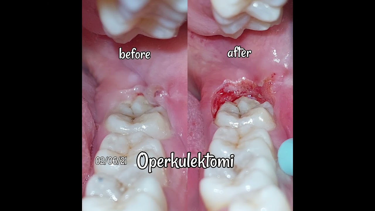 #operculektomi #electrocauter #drgheni proses operculektomi || drg heni ...