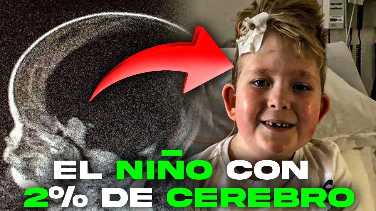 🧠¿Cómo es VIVIR SIN CEREBRO? El CASO que desafía los avances médicos ...