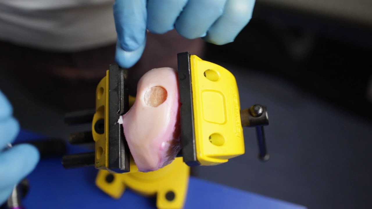 The Cartilage procedure ProChondrix Surgical Technique Overview - YouTube