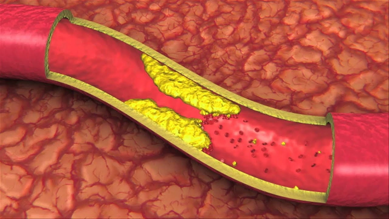 atherosclerosis animation - YouTube