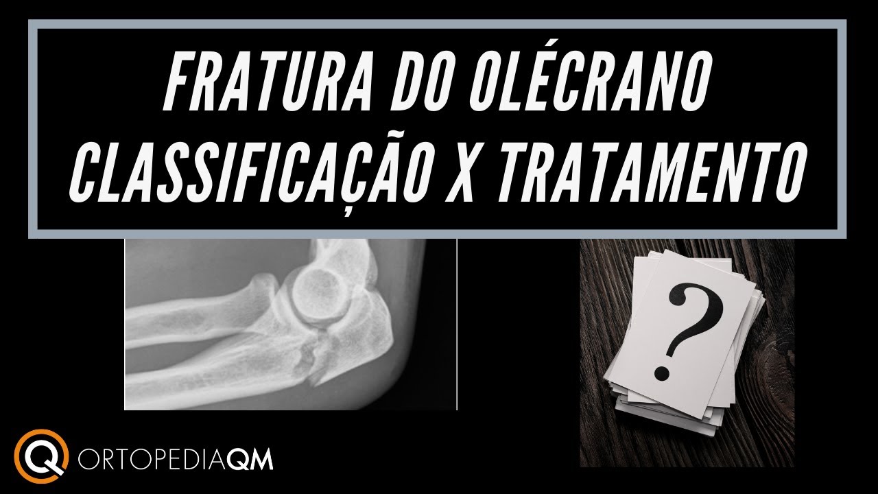 Classificação Mayo x Tratamento - Fratura do Olécrano - Ortopedia QM ...