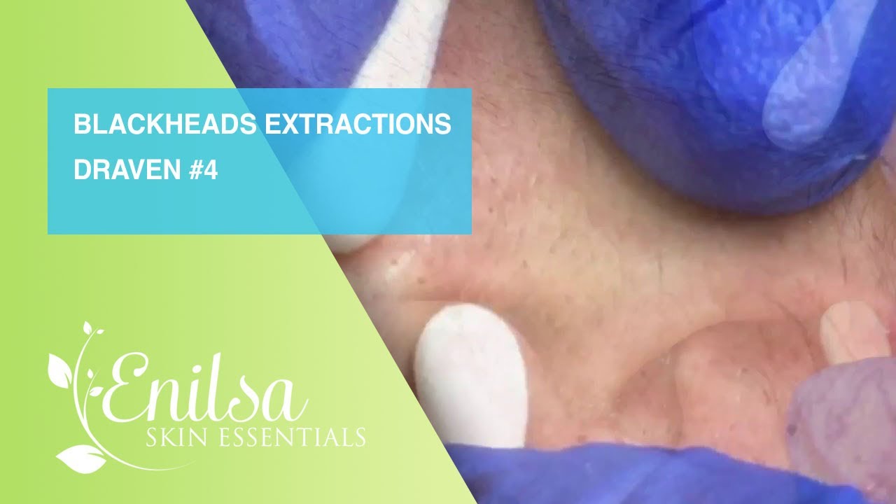 Blackheads Extractions Draven 4th Treatment - YouTube