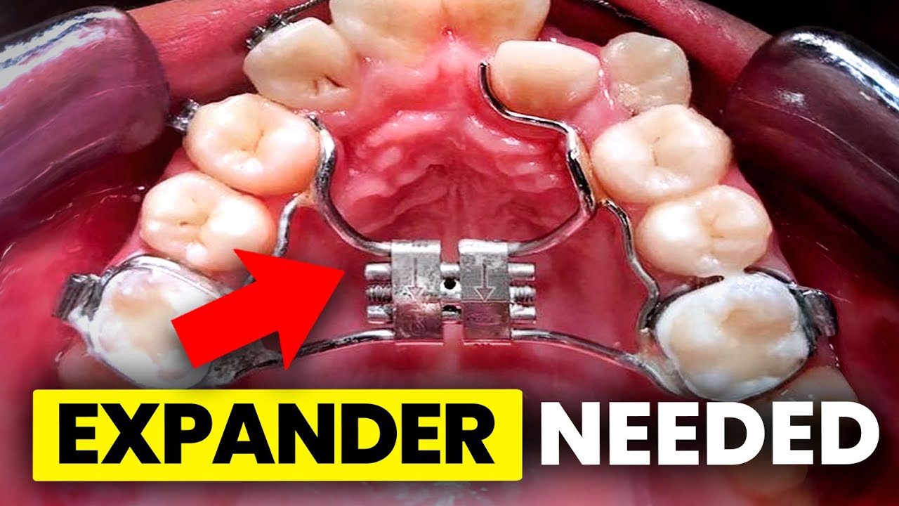 When do you NEED an Expander?...[everything you need to know ...