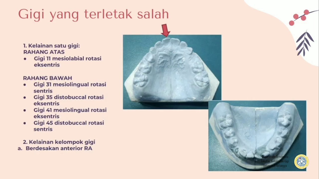 SCL Ortodonti A3 FKG Unair - YouTube