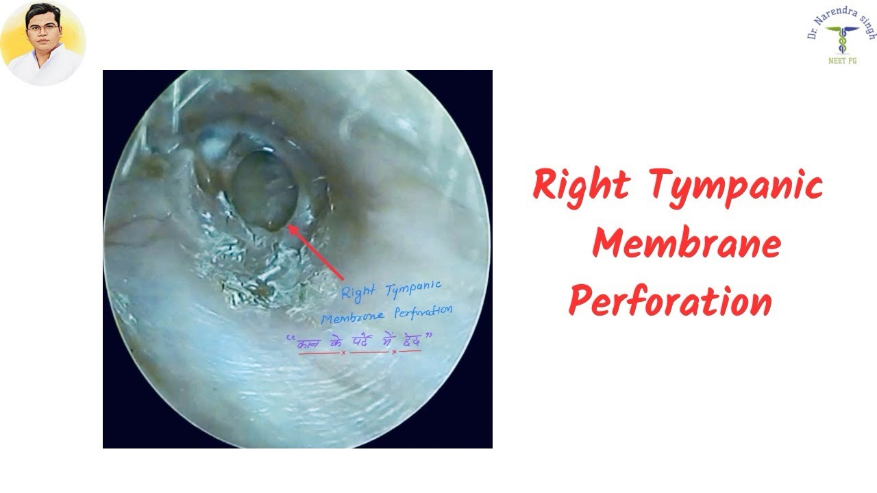 Right Tympanic Membrane Perforation/ कान के पर्दे मैं छेद - YouTube