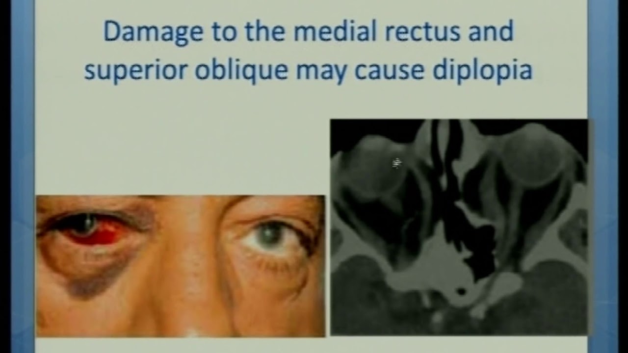 AIOC2018 - IC029 - Topic - Complication management in DCR - Dr.Sudhir ...