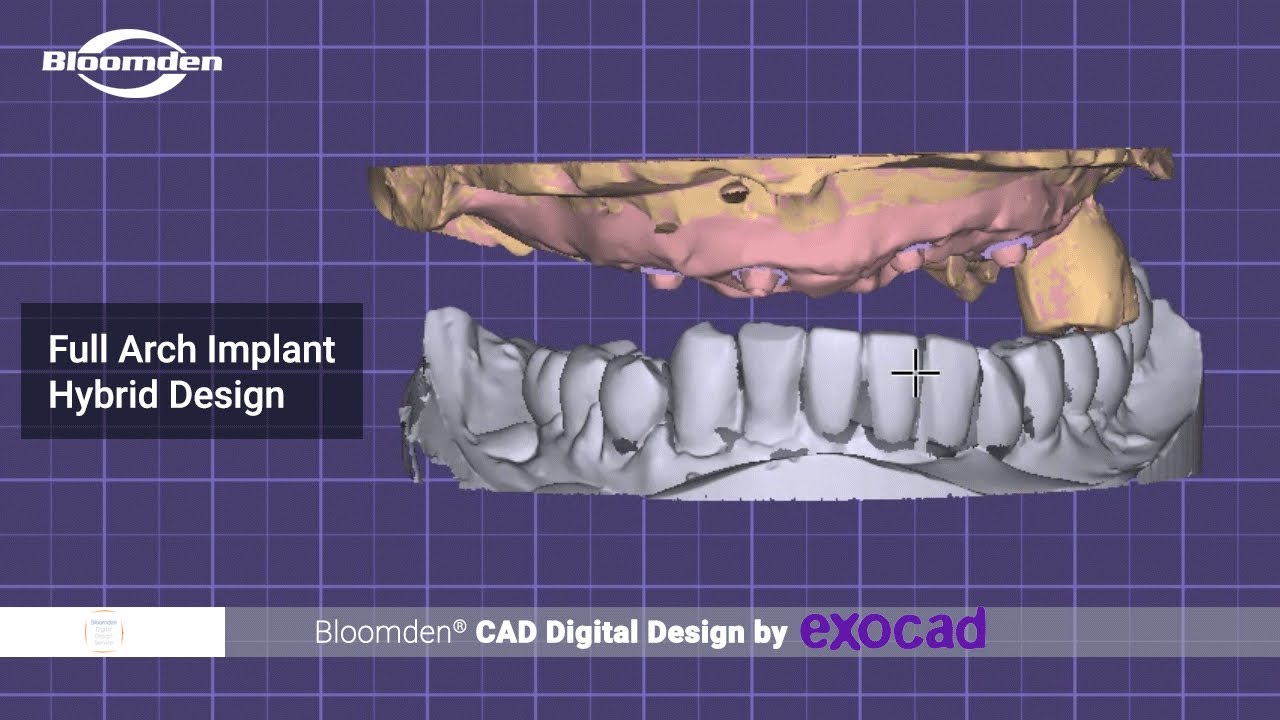 Full Arch Implant Hybrid Design by George - YouTube