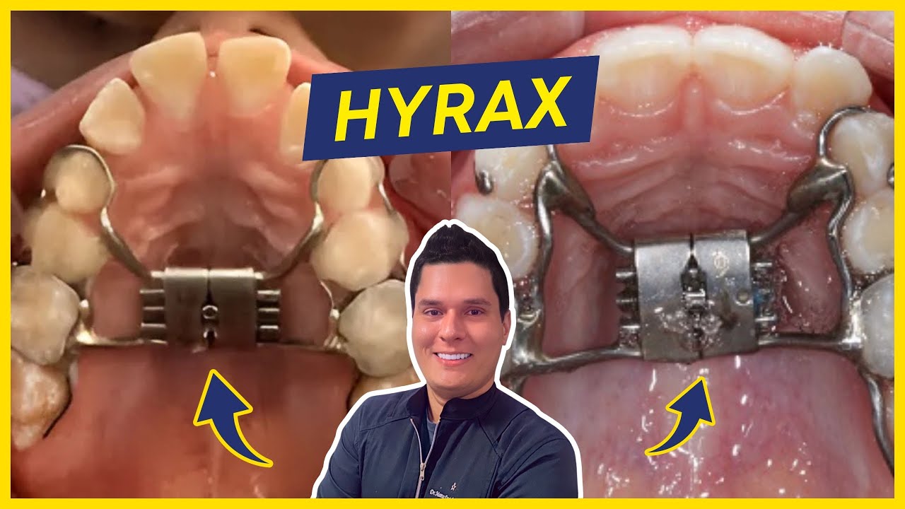 Aparelho Expansor Hyrax - Como funciona? (Protocolo de Uso) - YouTube