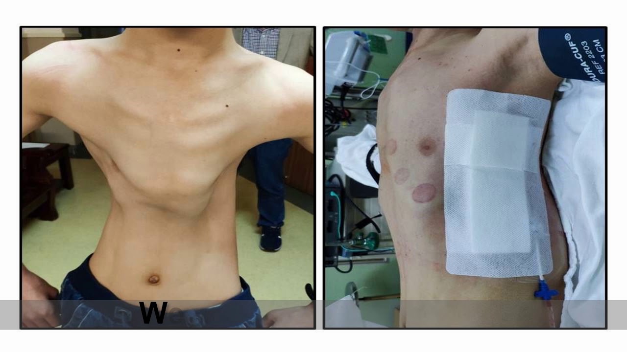 Complex Thoracic Deformity Operation Completed by Dr Wang Wenlin 复件 ...