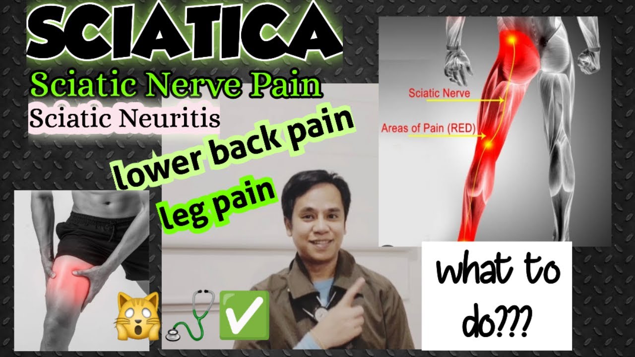 SCIATICA or Nerve pain (sciatic neuritis), lower back pain, leg pain ...