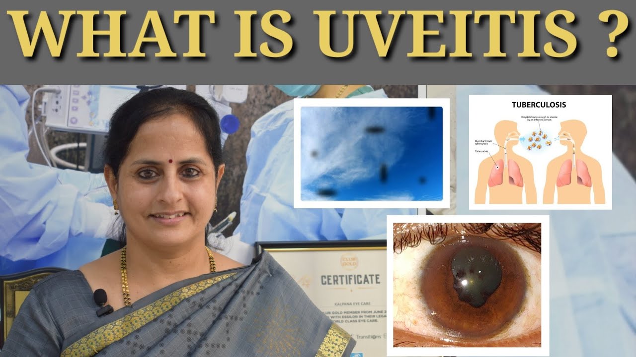Recurrent Red eyes? Not to miss Uveitis ! - YouTube