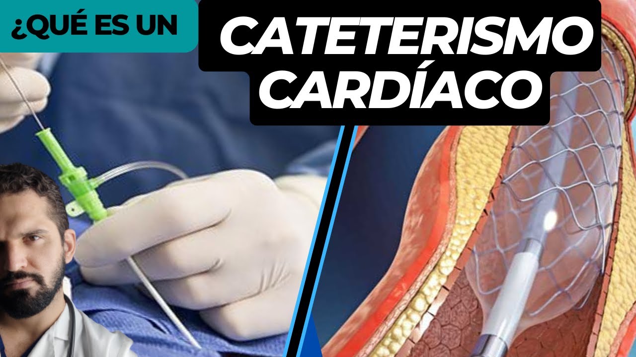 CATERISMO cardiaco y STENT. 💉 RIESGOS e indicaciones - YouTube