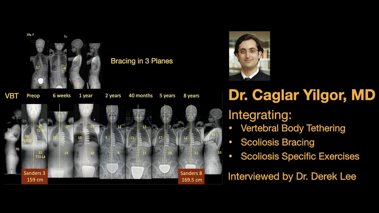 Dr. Caglar Yilgor MD, Integrating VBT, Bracing and Scoliosis Specific ...