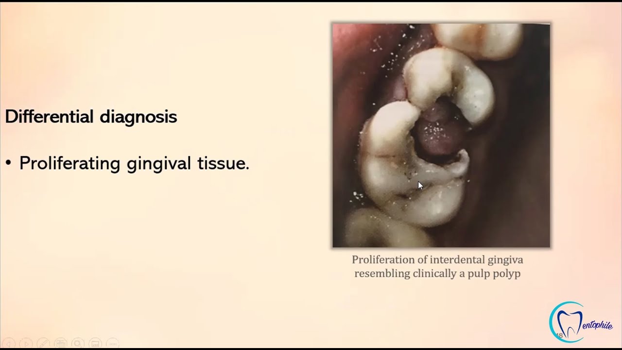 Chronic Hyperplastic Pulpitis