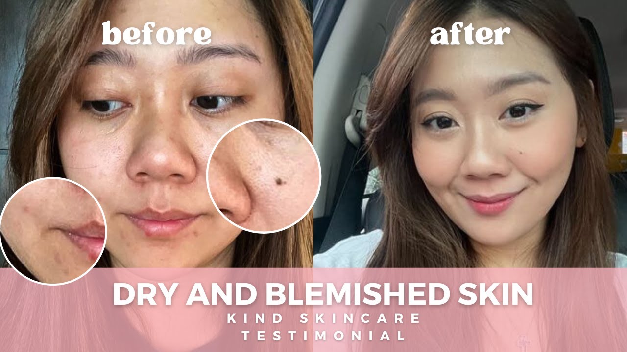 Dry and Blemished Skin Routine | Kind Skincare Testimonial - YouTube