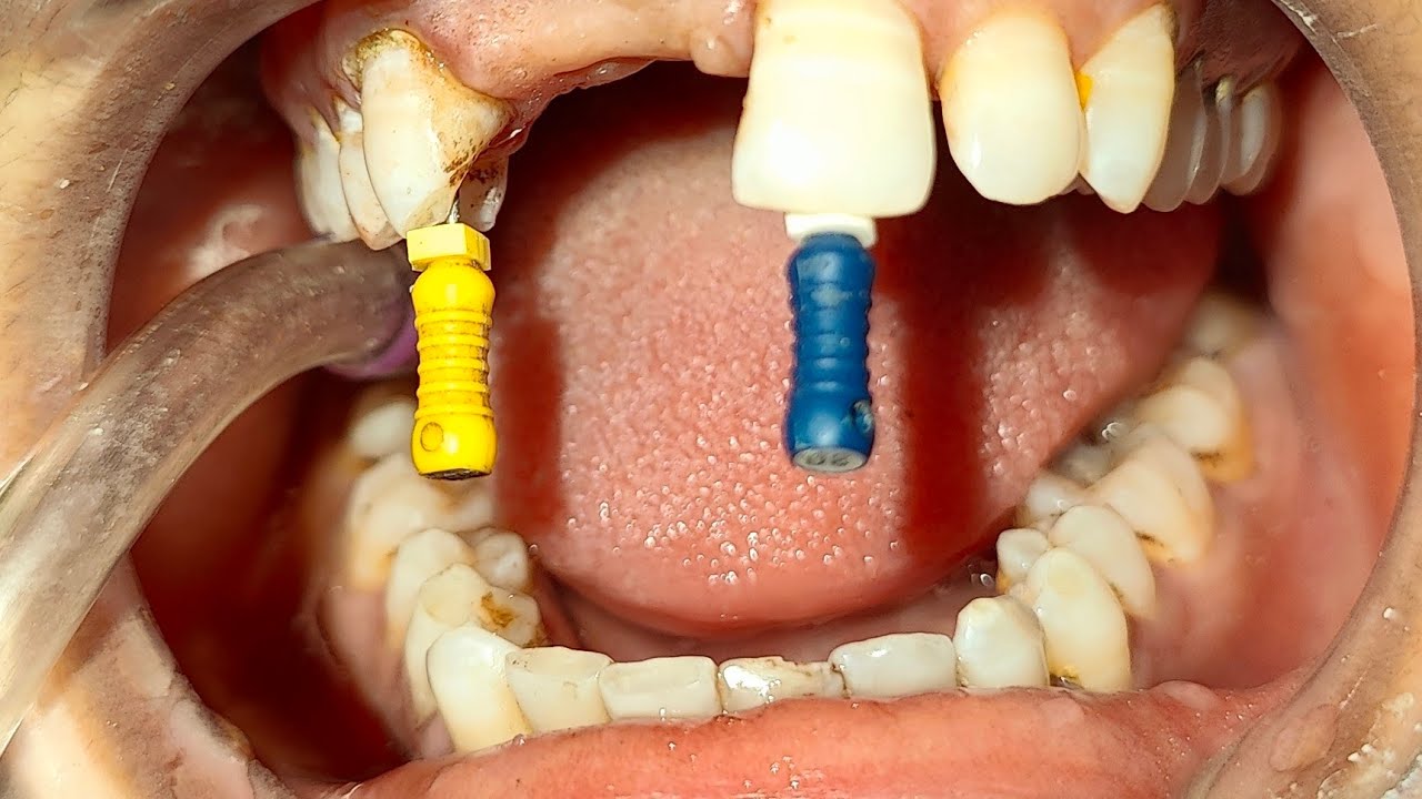 A OLD CITIZENS PERSON IMPLEMENT immediately #partial #denture on uper ...