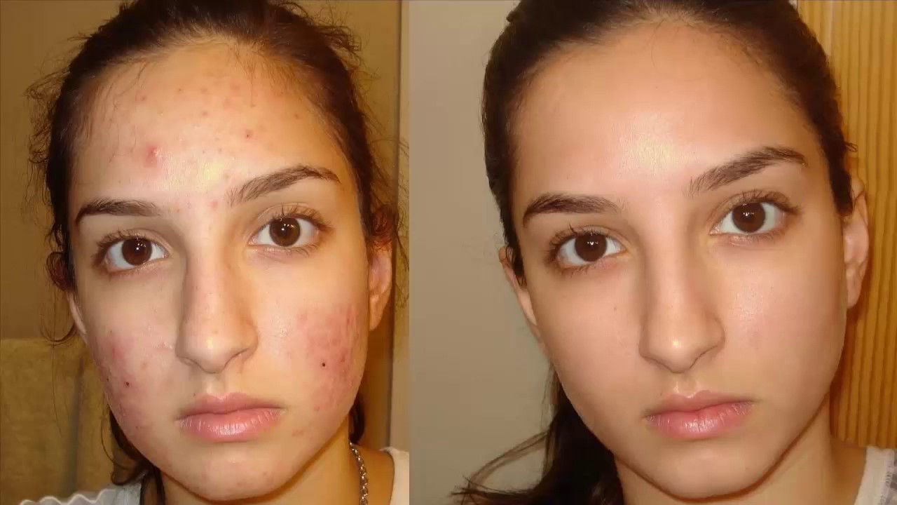 Comment SE DÉBARRASSER d’ACNE - 💐🍅 comment se débarasser de l'acné et ...