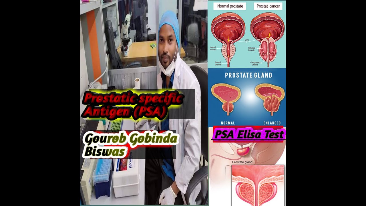PSA Elisa test procedure in Bangla. Prostatic Specific Antigen (PSA ...