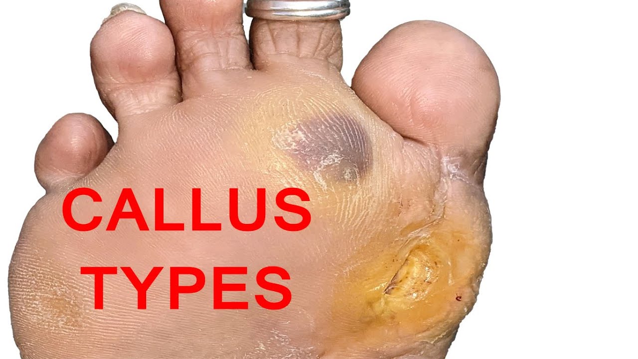 Callus Types / Stages Before After in a Diabetic - YouTube