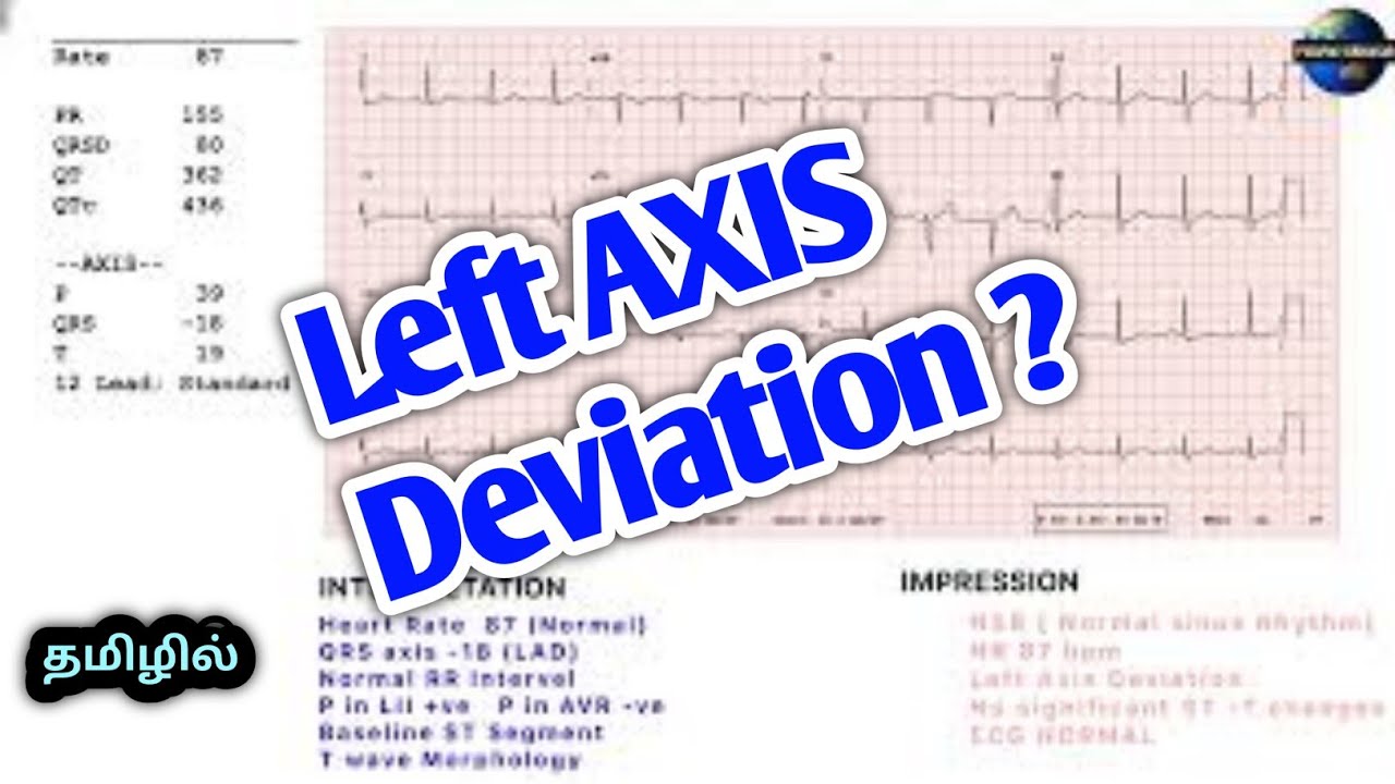 ECG - 3 LEFT AXIS DEVIATION - YouTube