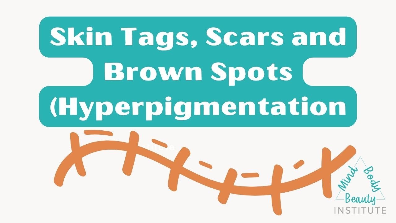Skin Tags, Scars and Brown Spots (Hyperpigmentation) - YouTube
