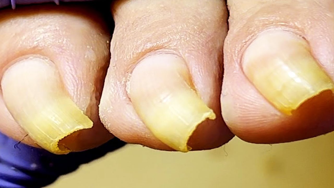 Long And Curly Toenails, Trimmed Silky~【Xue Yidao Pedicure】 - YouTube