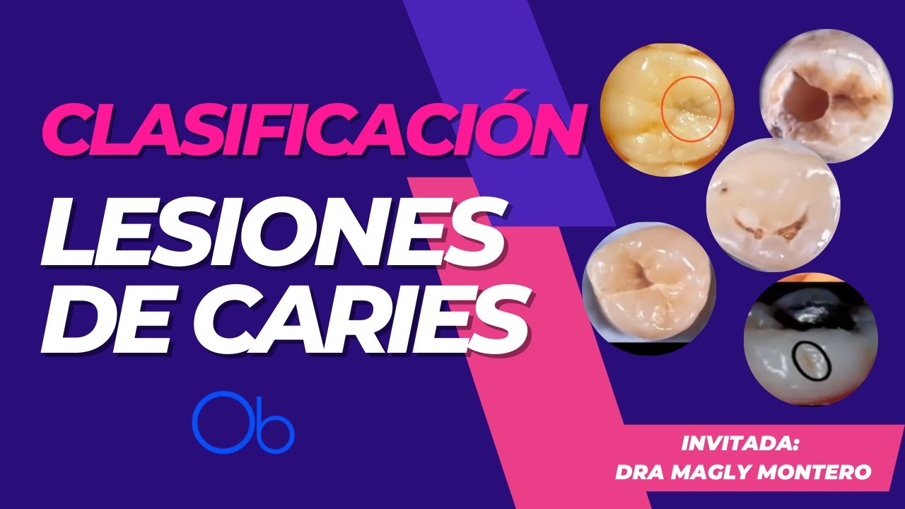 Clasificación de lesiones de Caries Dental 🦷 - YouTube