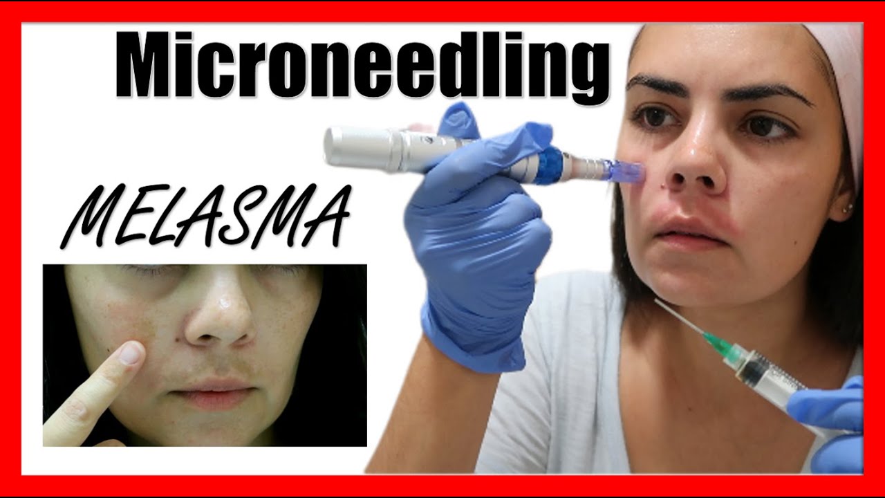 ¿Cómo ELIMINAR el MELASMA con MICRONEEDLING? Dermapen en CASA Ácido ...