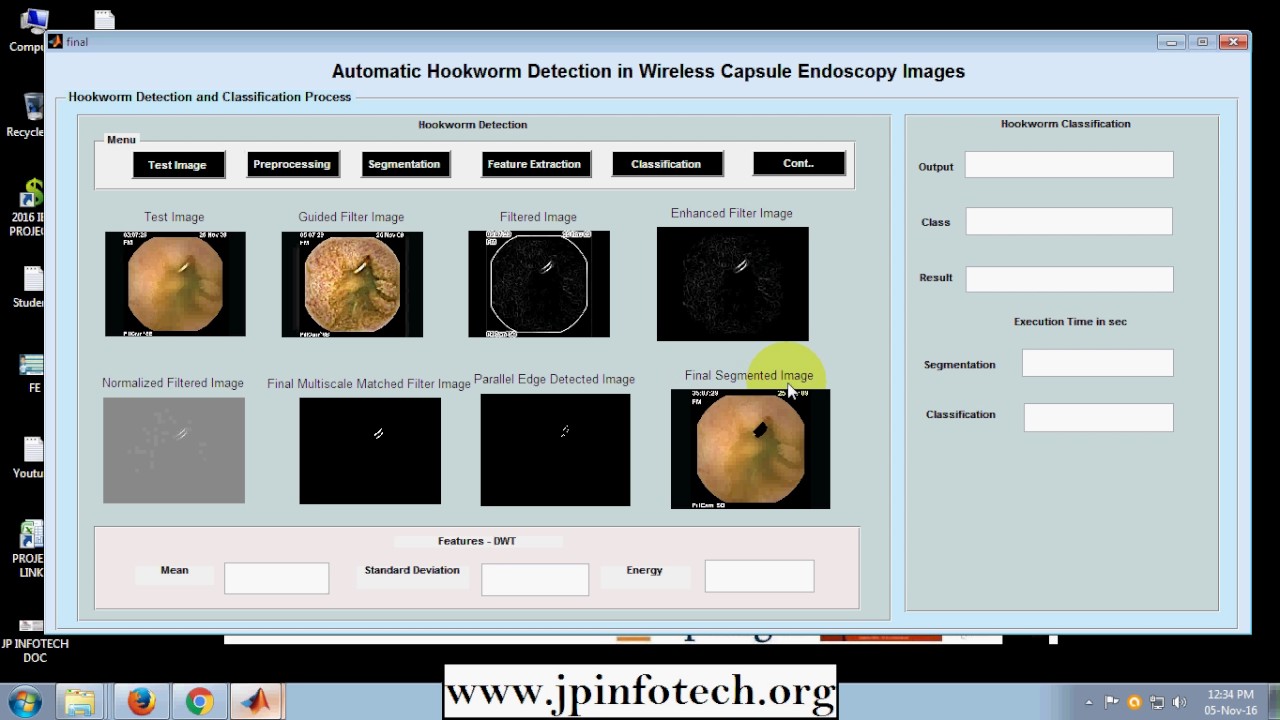 Glaucoma Detection Using Image Processing Matlab Project Source Code
