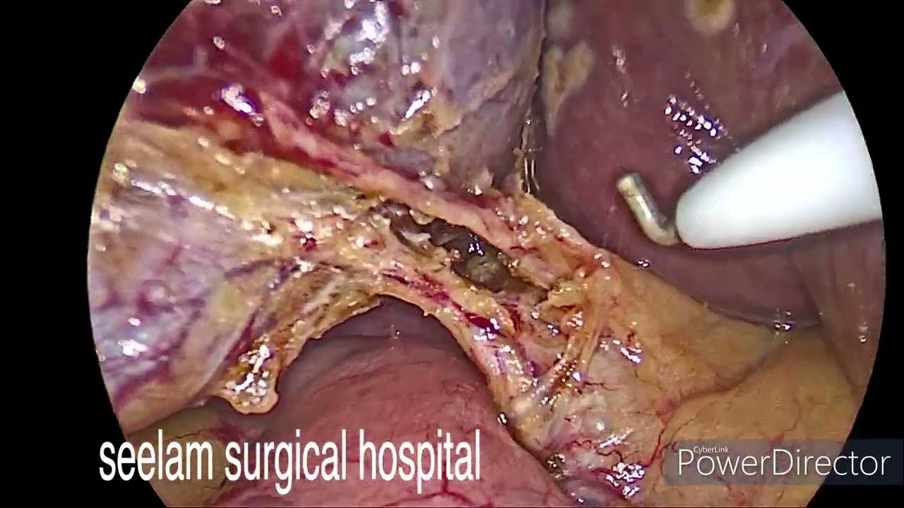 Simple/Safe Laparoscopic Cholecystectomy - YouTube
