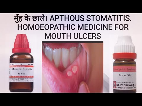 मुँह के छाले।।Mouth ulcers।।Homoeopathic treatment For apthous ...