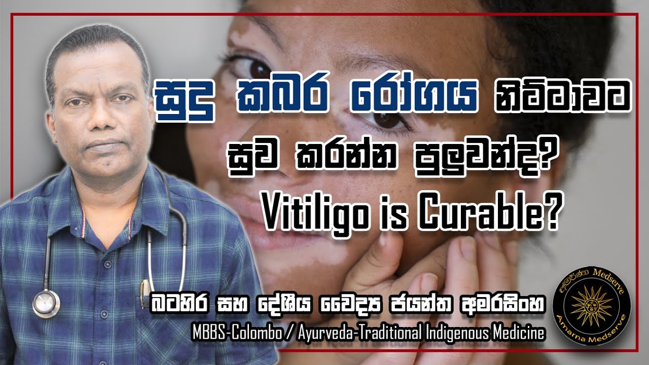 සුදු කබර රෝගය නිට්ටාවට සුව කරන්න පුලුවන් ද? | Vitiligo is Curable ...