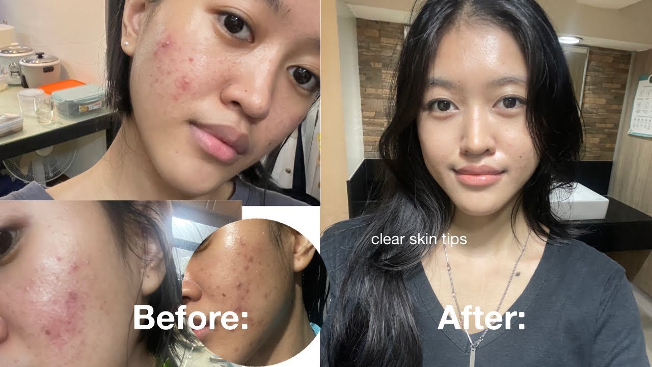 how I cleared my skin (without ACCUTANE) 🫧 - YouTube