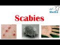 What is scabies as UK doctors report 'nightmare' surge in condition ...