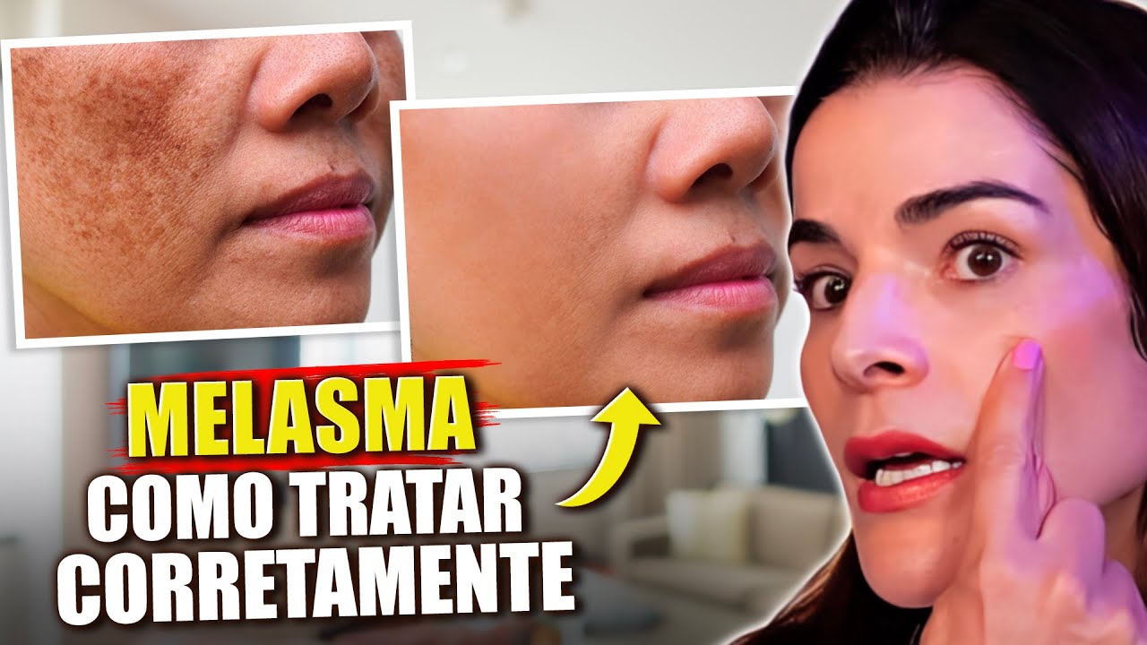 O Que é e Como Tratar o MELASMA! Resultado MARAVILHOSO! - YouTube