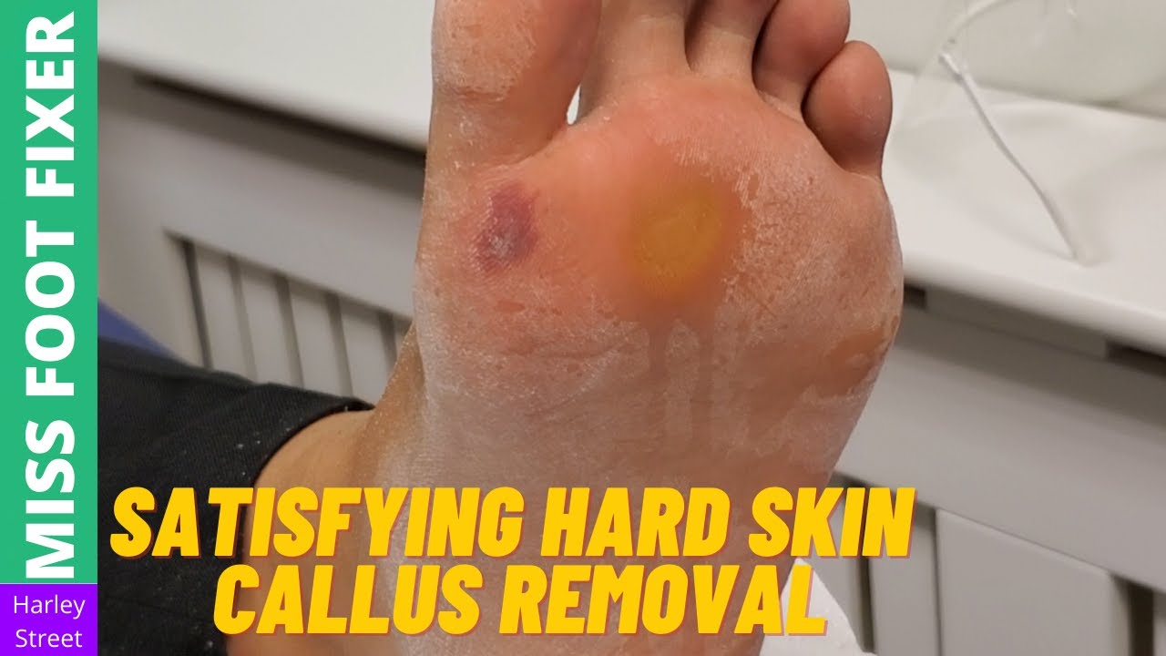 Satisfying hard skin [ callus removal ] | Miss Foot Fixer | Marion Yau ...