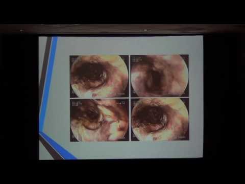 Esofagitis por cáusticos - YouTube