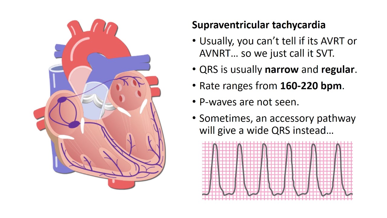 Types of Tachyarrhythmias - YouTube