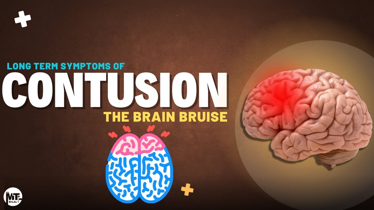 Brain Contusion/Concussion in 2 minutes| Prevention & long-term effects ...