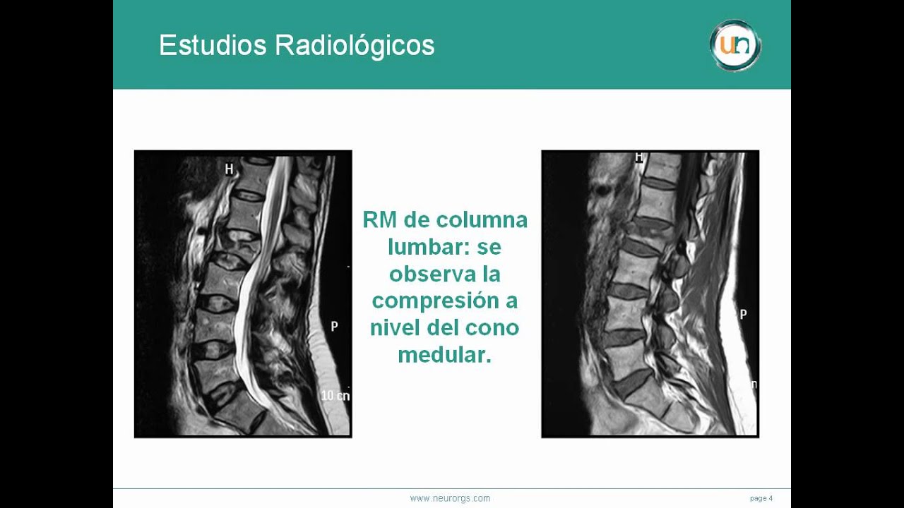 Neurorgs.net-Fractura lumbar por accidente deportivo - YouTube