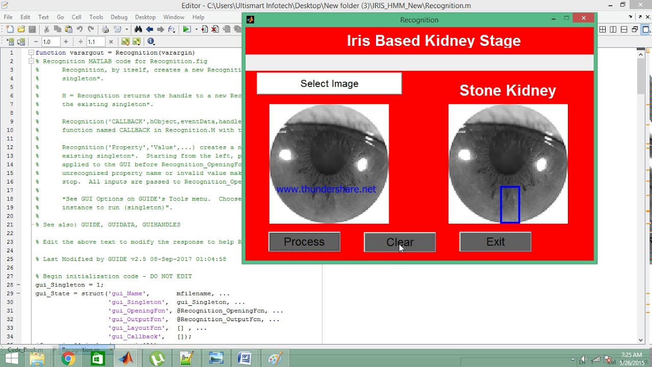 IRIS Based Kidney Decease Detection - YouTube
