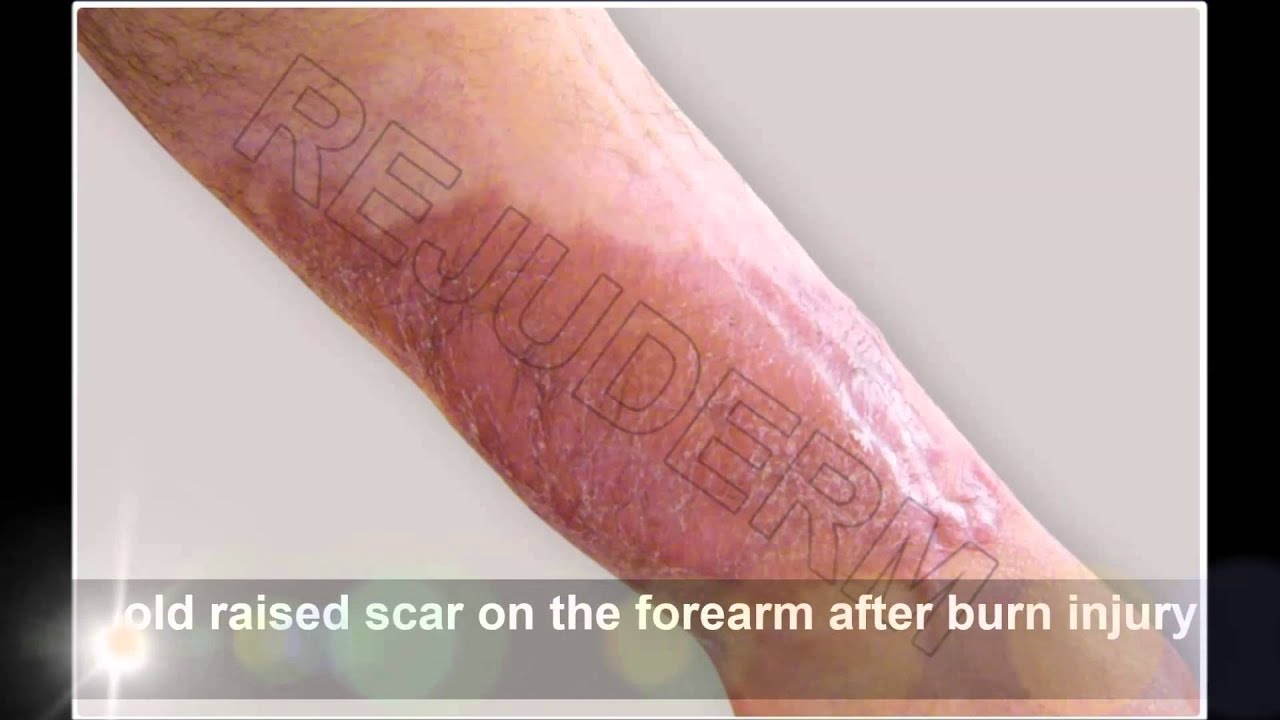 REJUDERM Scar care cream Old raised scar on the forearm after burn ...
